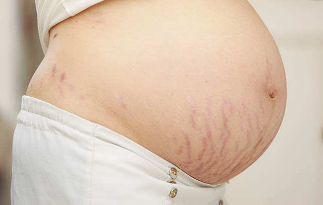 Causes and home remedies for stretch marks | femina.in