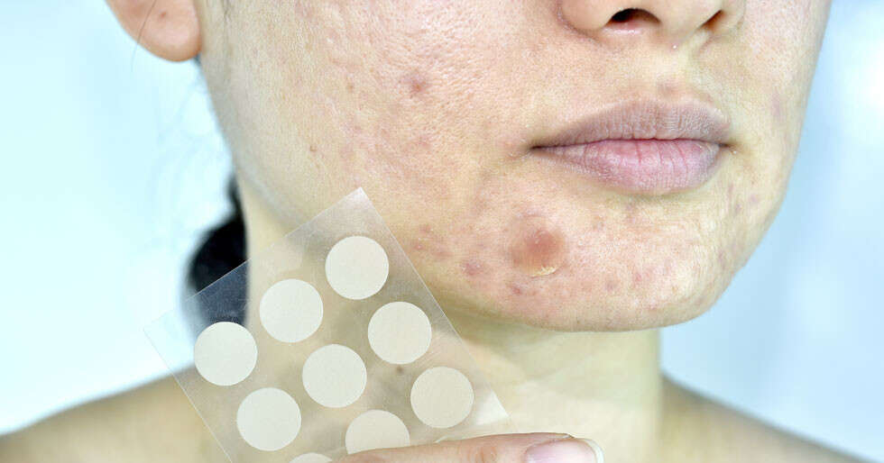 All you need to know about pimple patches | Femina.in