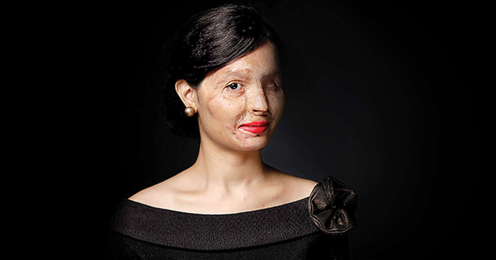Reshma Qureshi: The acid attack survivor inspiring millions | Femina.in