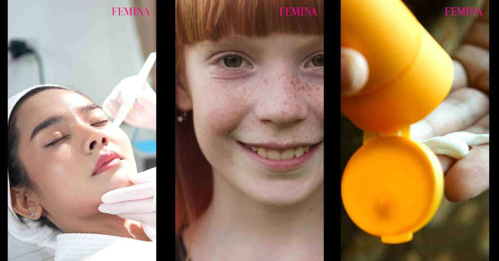 7 Amazing Ways On How To Get Rid Of Freckles