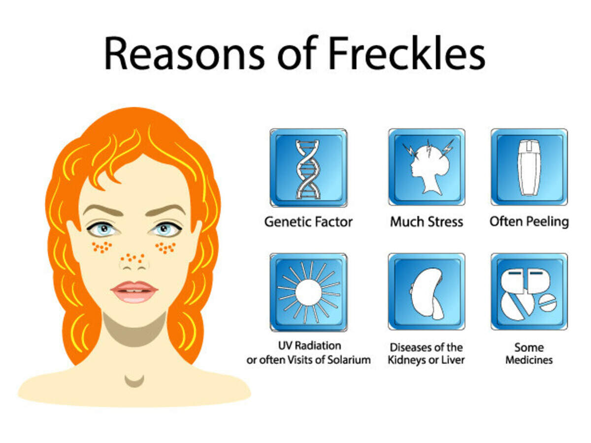 How To Get Rid Of Freckles Without Makeup | Saubhaya Makeup